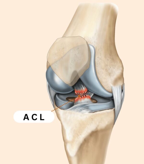 Best Hospital For ACL Surgery In Bangalore